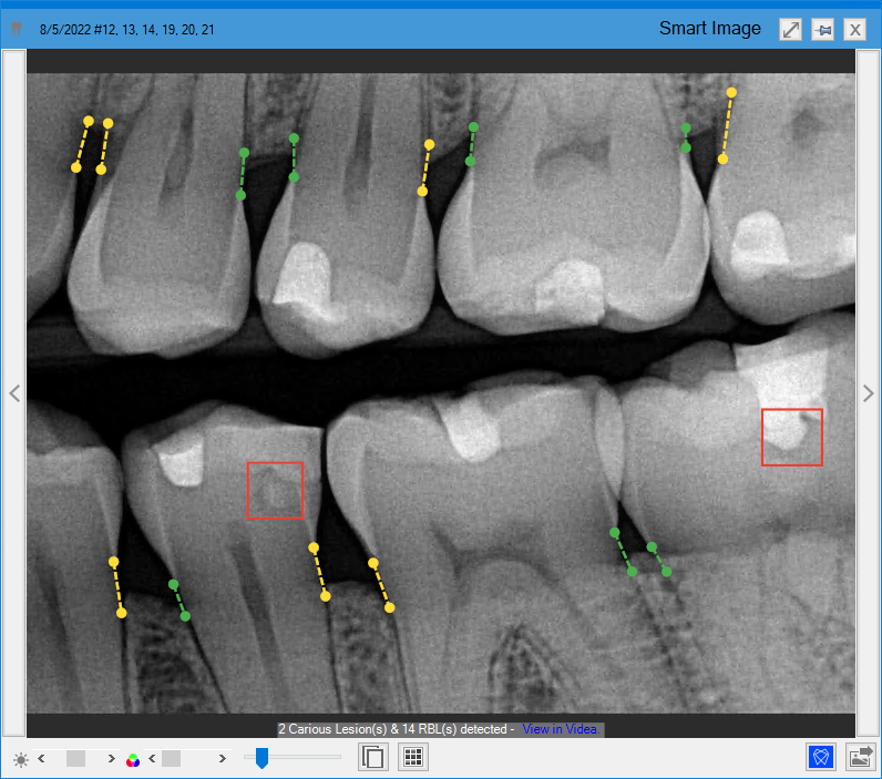 Measuring interproximal Radiographic Bone Levels in Dentrix Detect AI